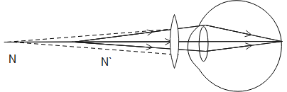 what are the causes of presbyopia, draw labeled diagram of a lens used for the correction of ...